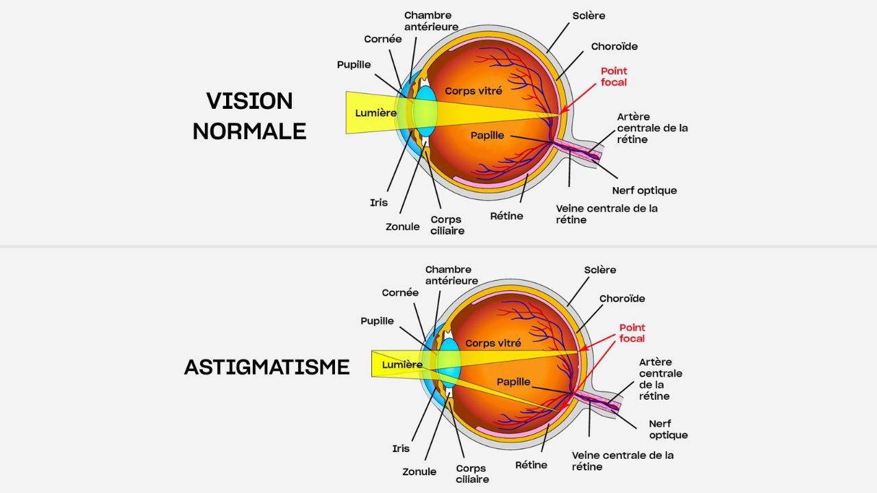 Myope, hypermétrope, astigmate et presbyte : connaissez-vous la ...