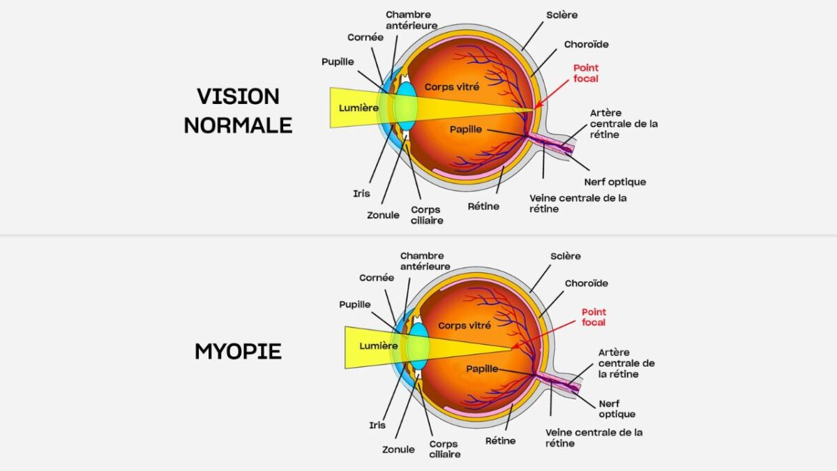 Myope, hypermétrope, astigmate et presbyte : connaissez-vous la ...